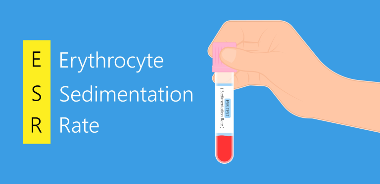 Erythrocyte Sedimentation Rate (ESR) Purpose, Procedure| LTI